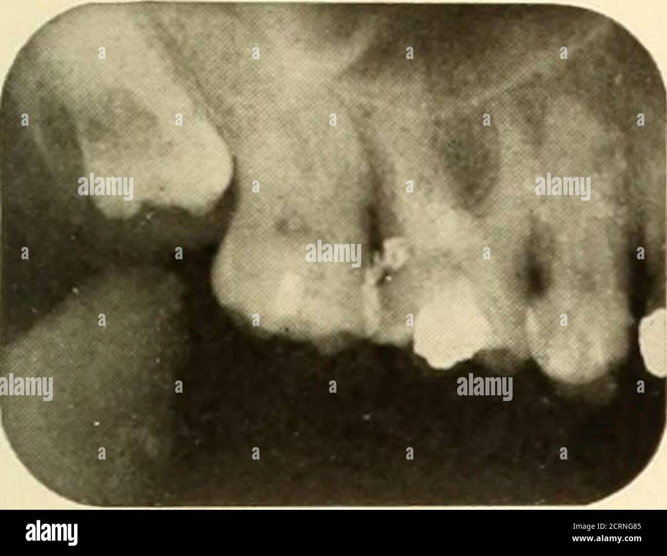 Hamular Notch Radiograph