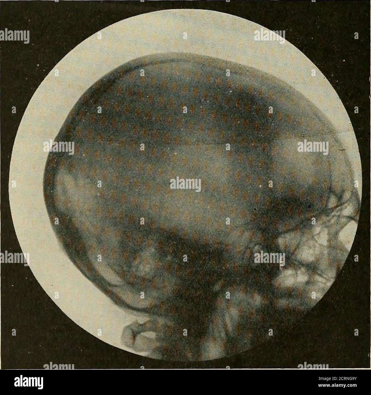 . Radiography and radio-therapeutics . Fig. 159.—Shrapnel bullet in ...