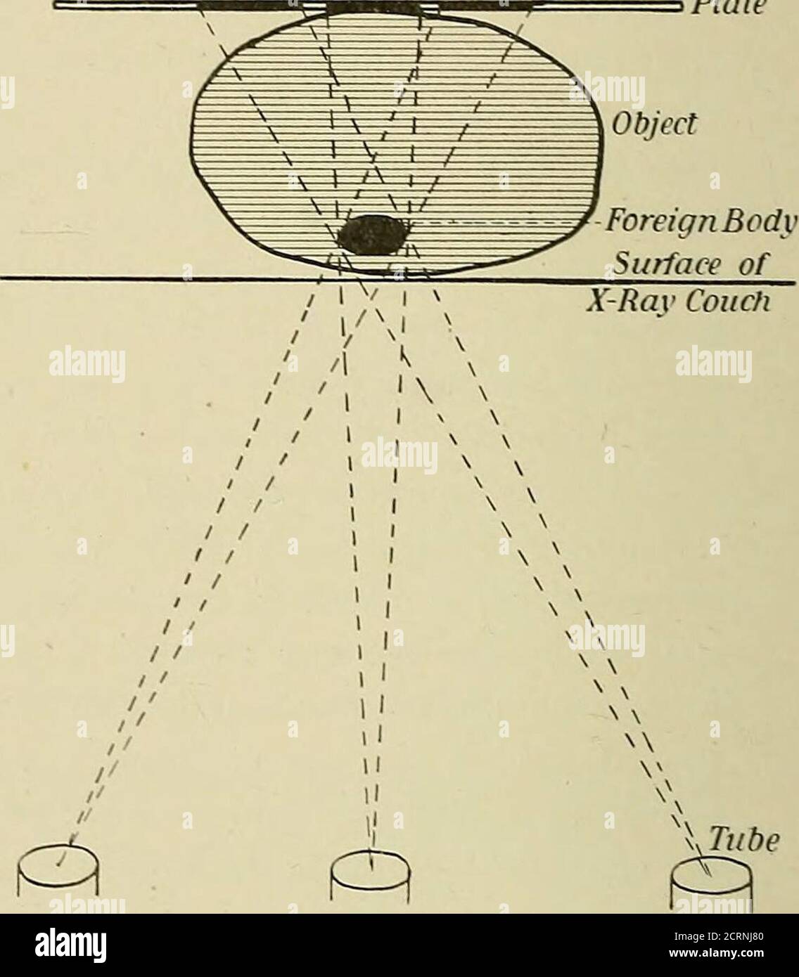 . Radiography and radio-therapeutics . Tube -Foreign BodyObject Plate ...