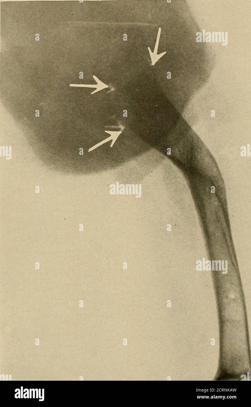 Transverse bone fracture hi-res stock photography and images - Alamy