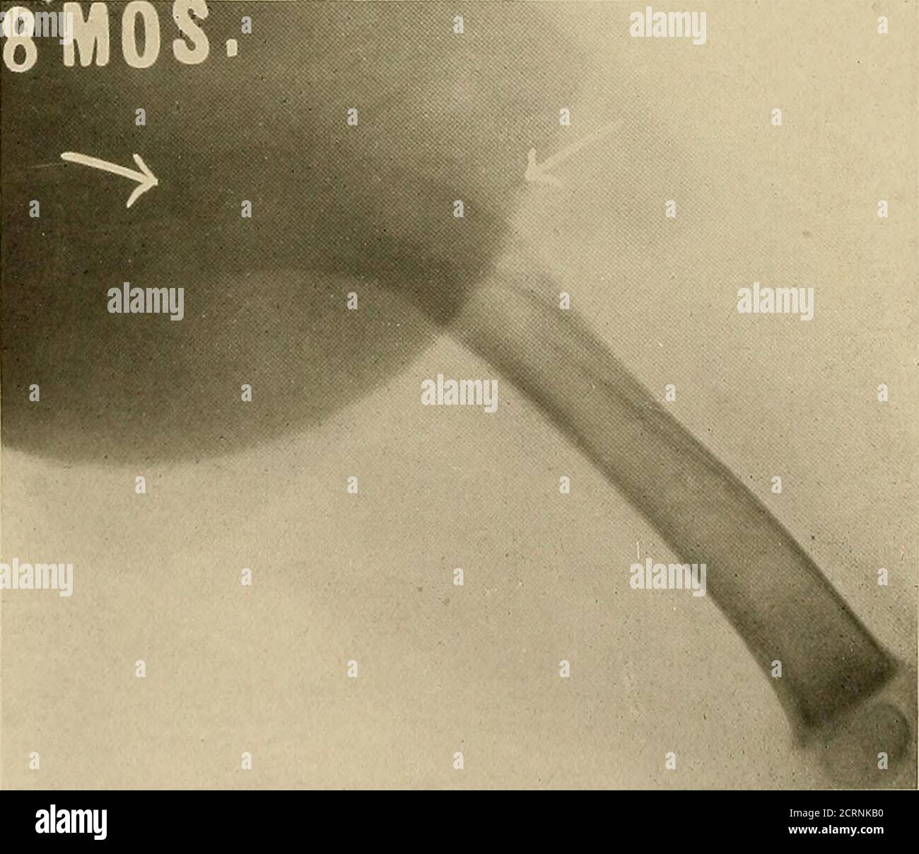 Lateral position birth hi-res stock photography and images - Alamy