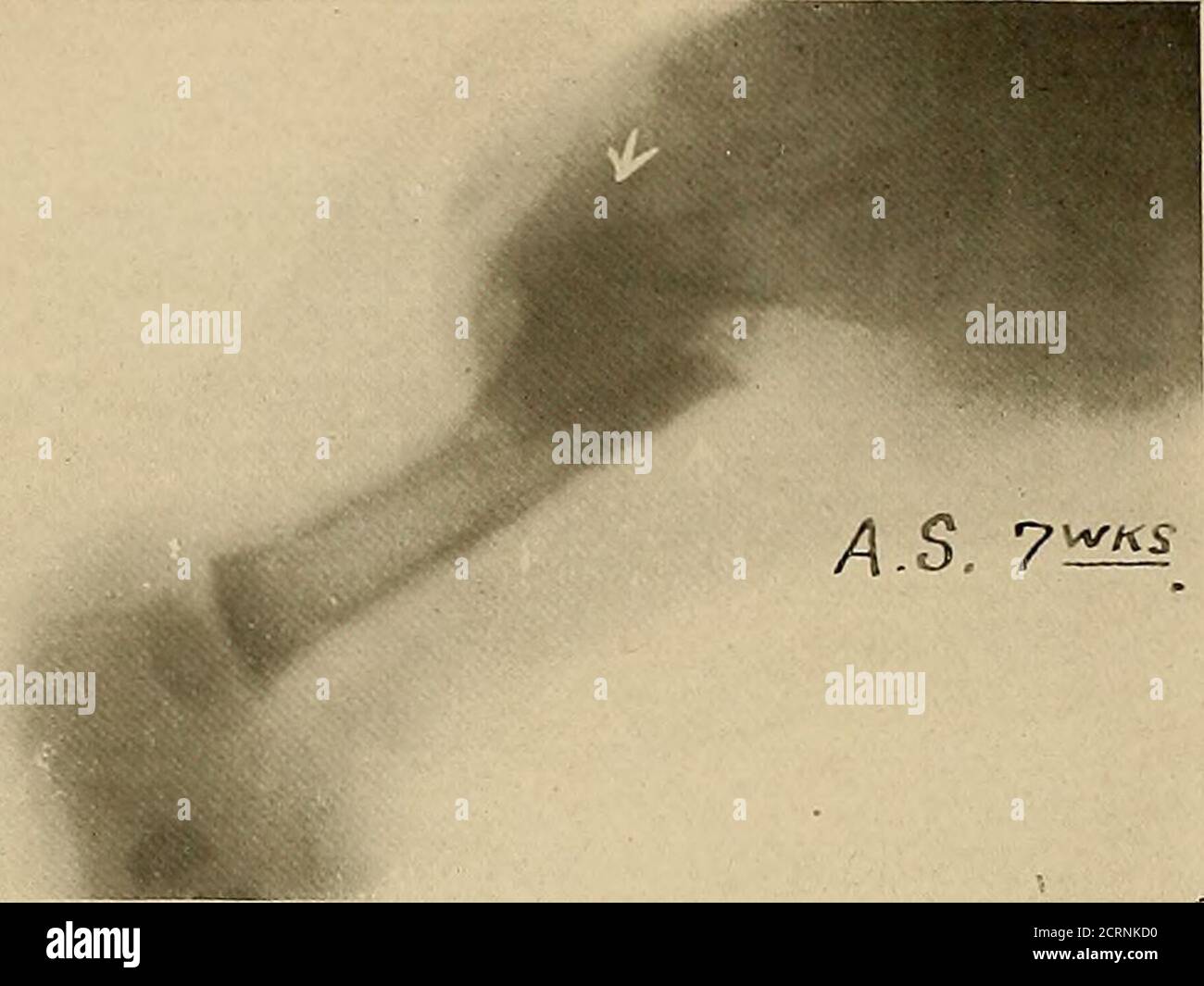 . Birth fractures and epiphyseal dislocations . Fig. 63.—Case i. The ...