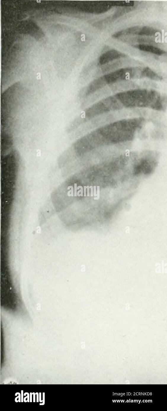 Lower lobe consolidation hi-res stock photography and images - Alamy