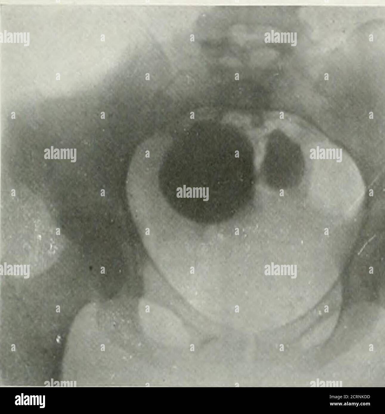 Enterolith hi-res stock photography and images - Alamy