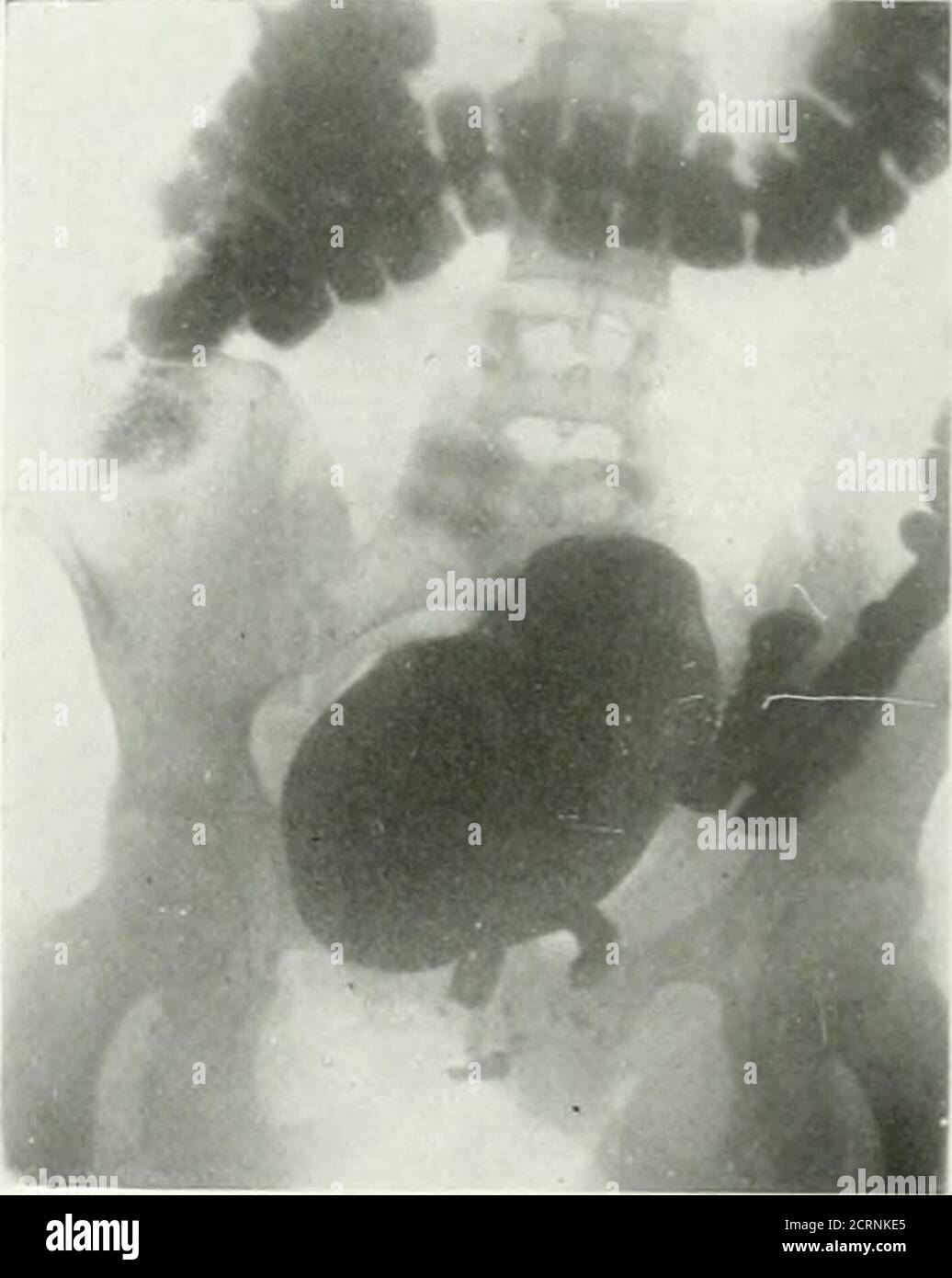 Barium meal hi-res stock photography and images - Alamy