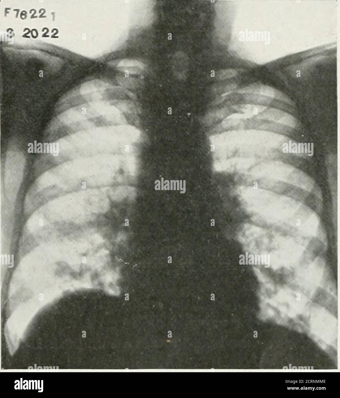 . The American journal of roentgenology, radium therapy and nuclear ...