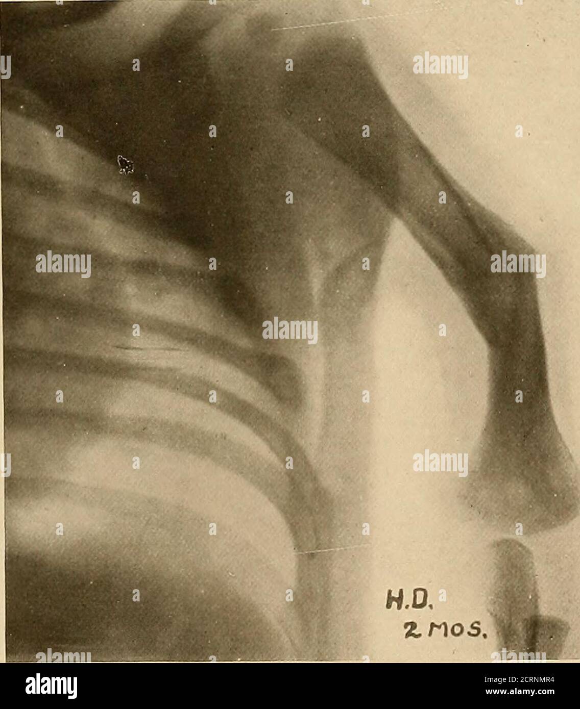 . Birth fractures and epiphyseal dislocations . KD.ZWKS. Fig. 35.—Cajf ...