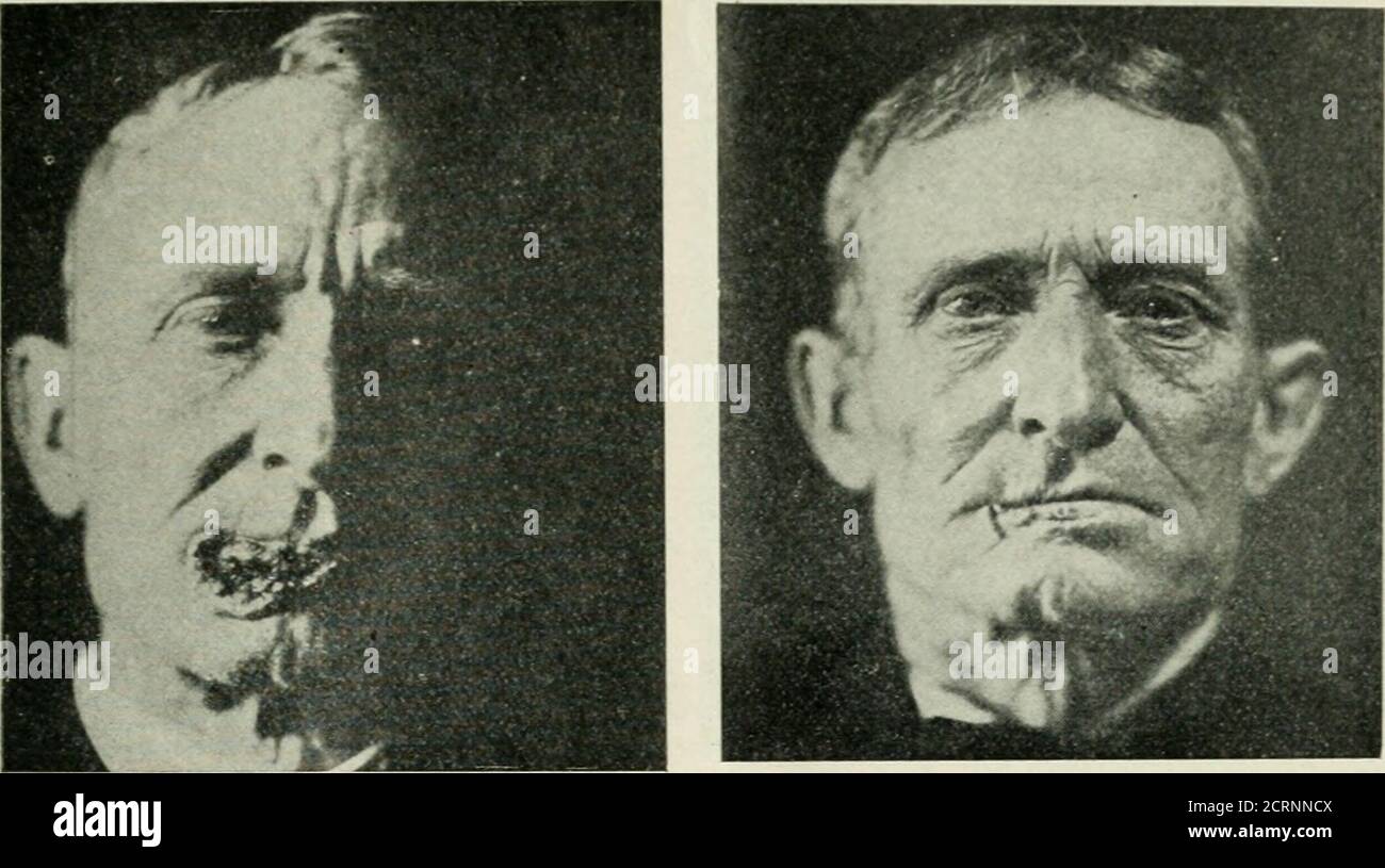 . Radium . ter radiumtreatment. once the lip has been invaded by cancer ...