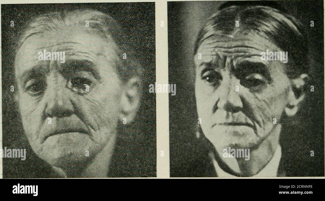 . Radium . Epithelioma of cheek. Result three months after treatment ...