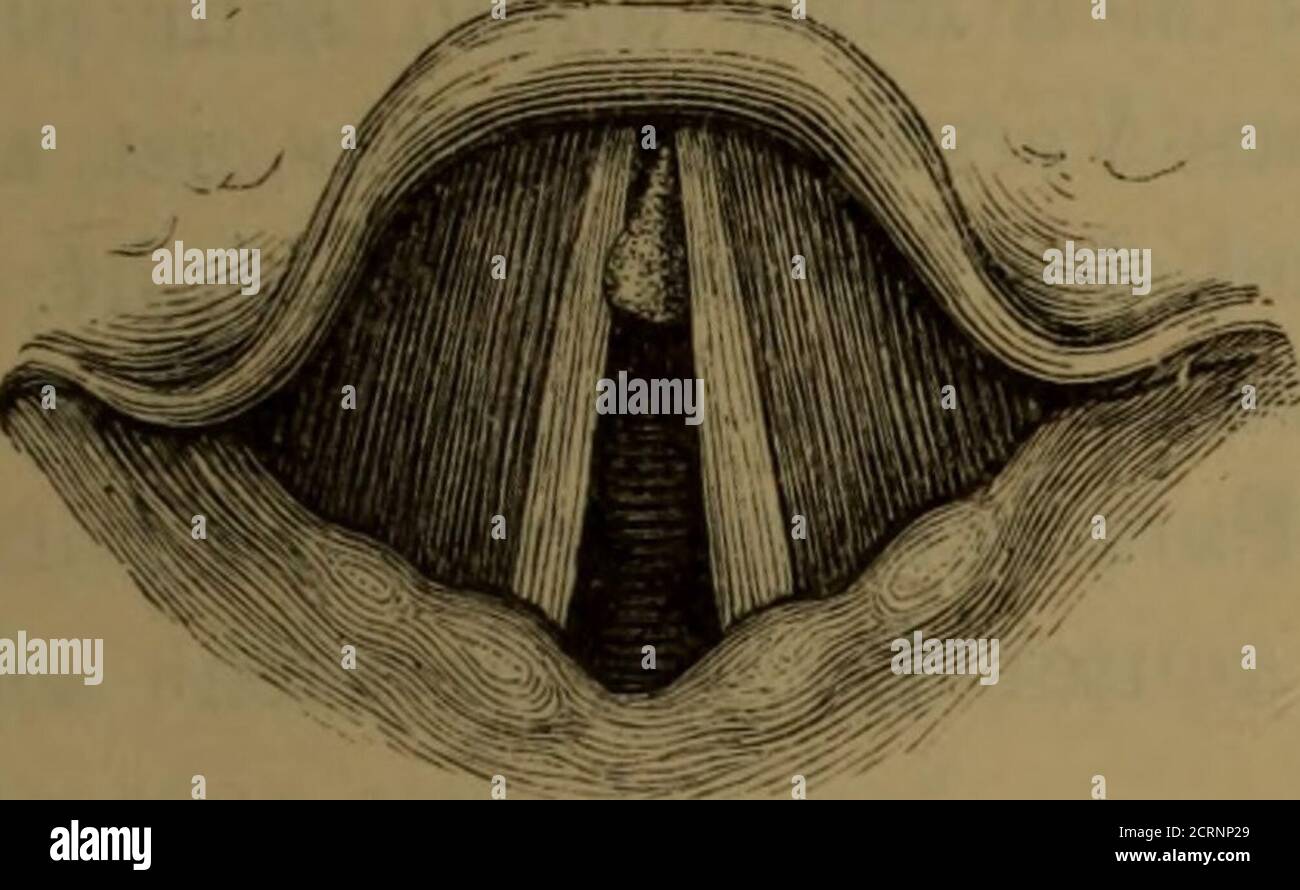 Gummata hi-res stock photography and images - Alamy