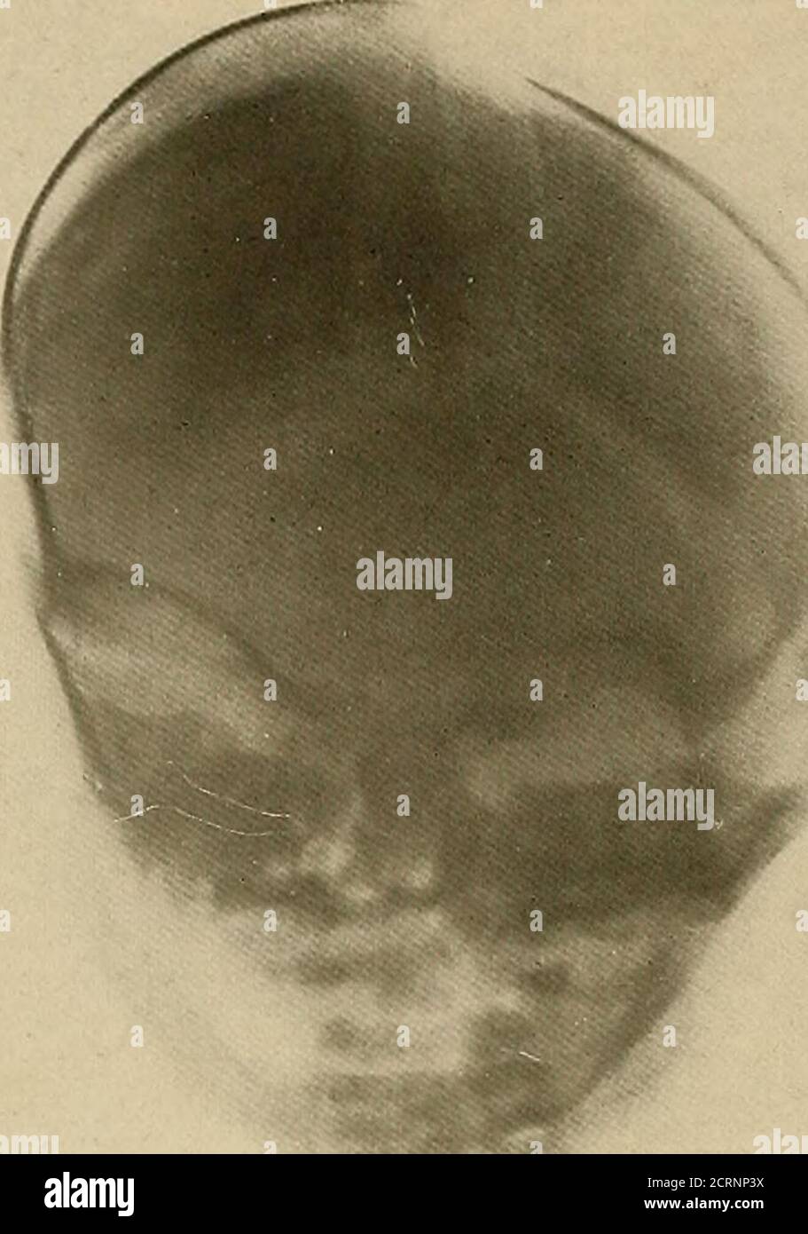 . Birth fractures and epiphyseal dislocations . ilG. 14.—Lasc 6 ...
