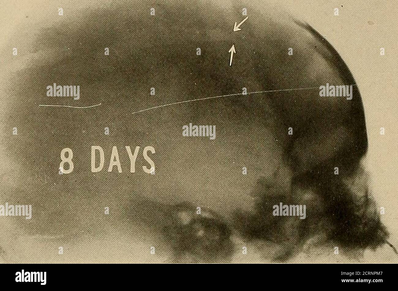 . Birth fractures and epiphyseal dislocations . Fig. 4.—Case 2. At the ...