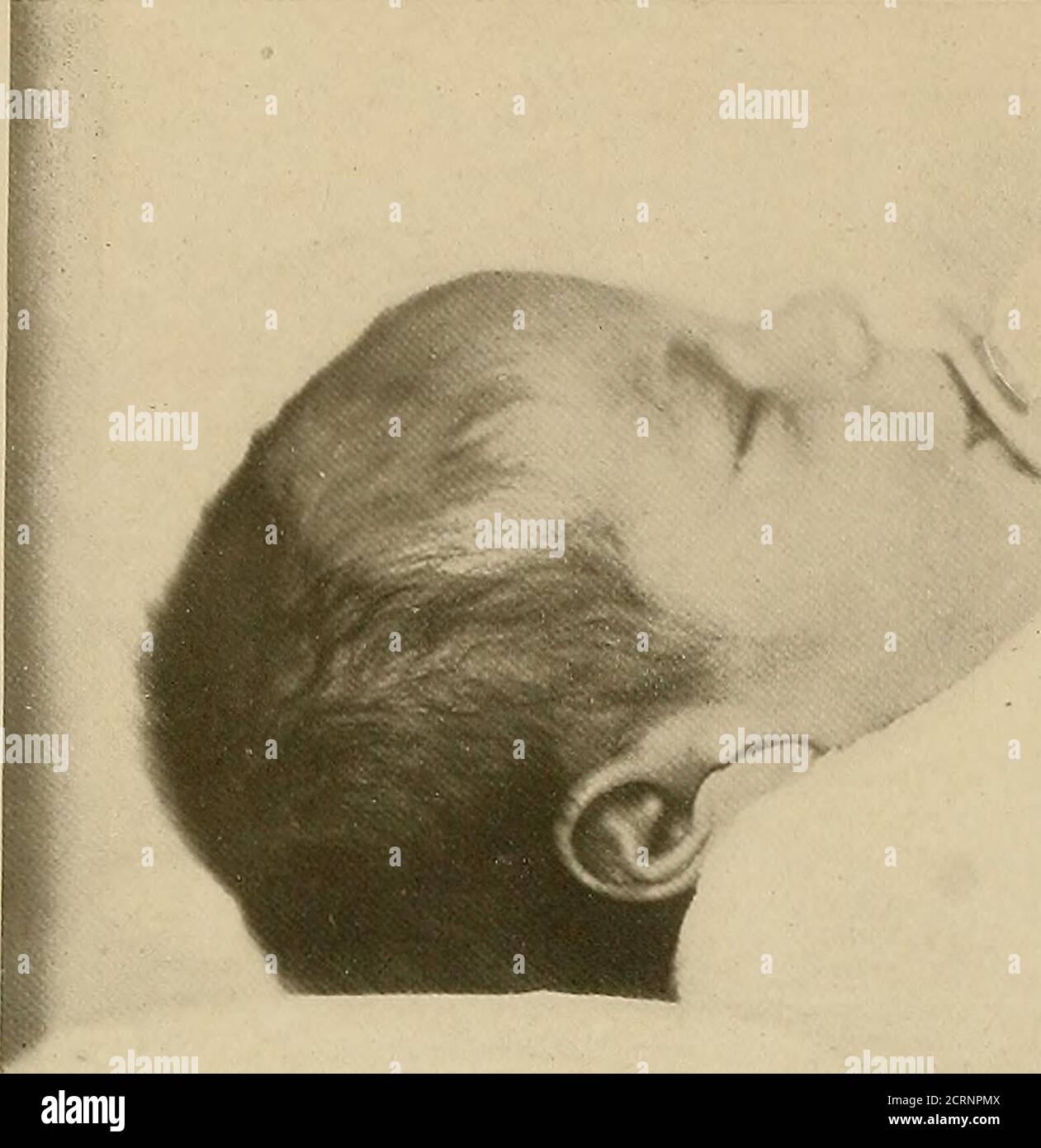 . Birth fractures and epiphyseal dislocations . Fig. 10.—Indentation of ...