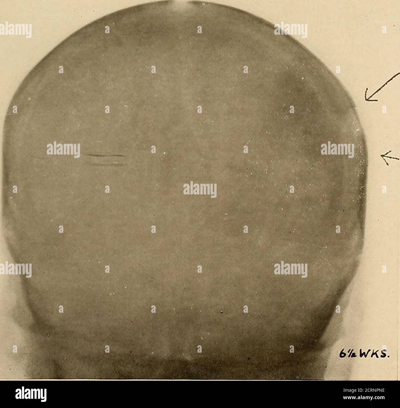 . Birth fractures and epiphyseal dislocations . Fig. 7.—Case 3. The ...