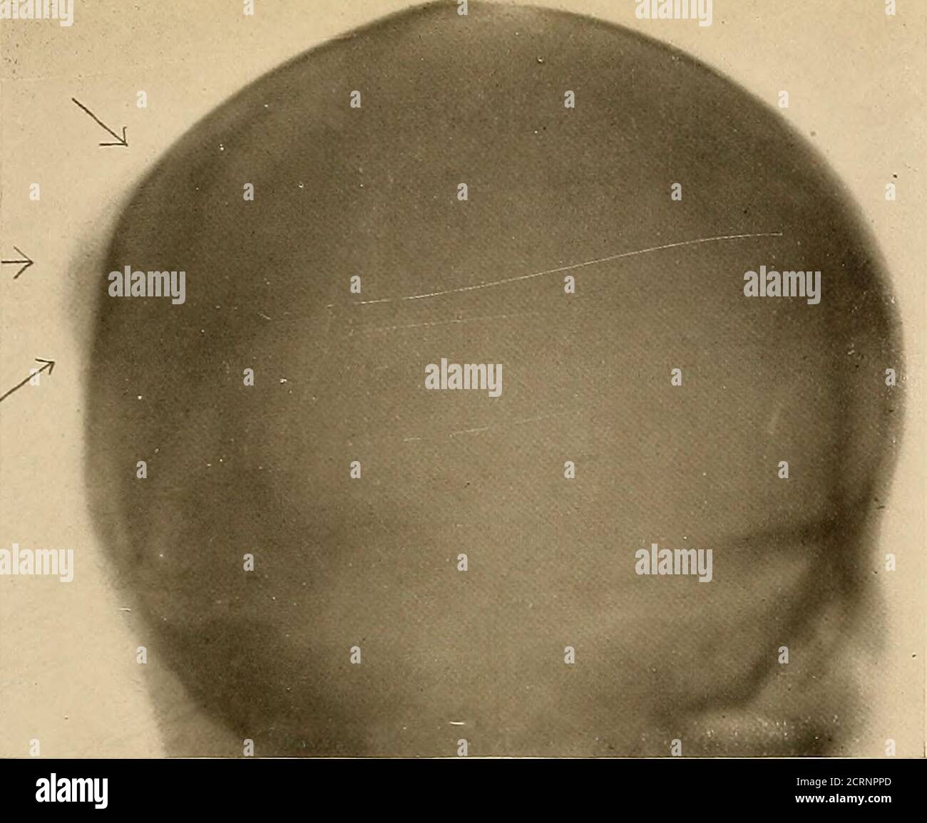 Parietalbone hi-res stock photography and images - Alamy