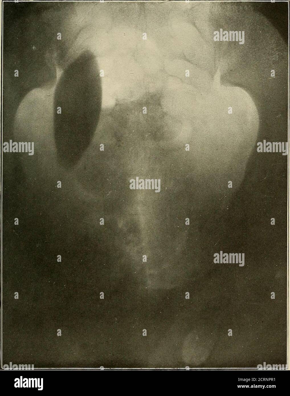 . A text-book of radiology . TWO CALCULI IN BLADDER.. LARGE CALCULUS IN ...