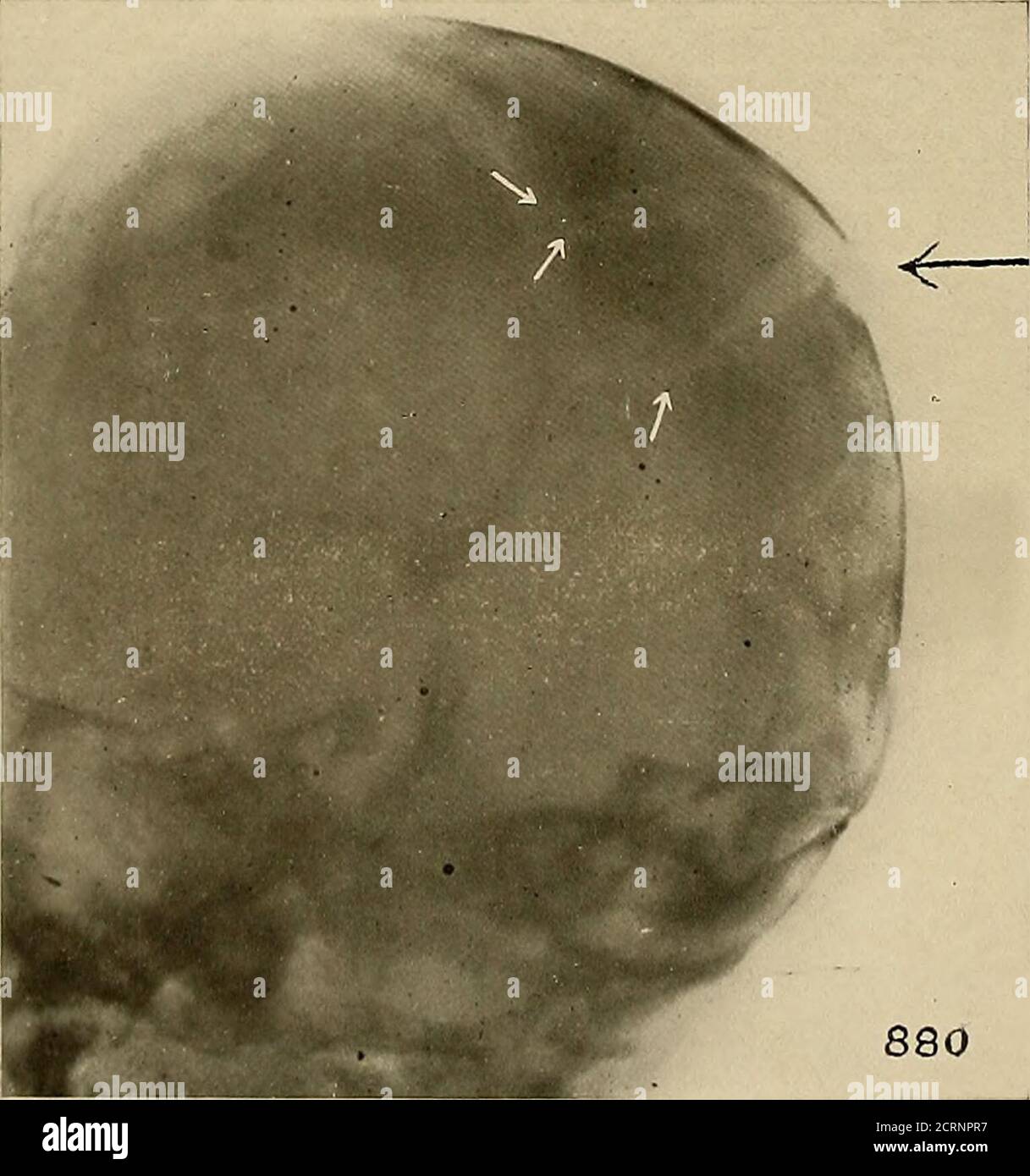 . Birth fractures and epiphyseal dislocations . Fig. 5.—Cast- 3 ...