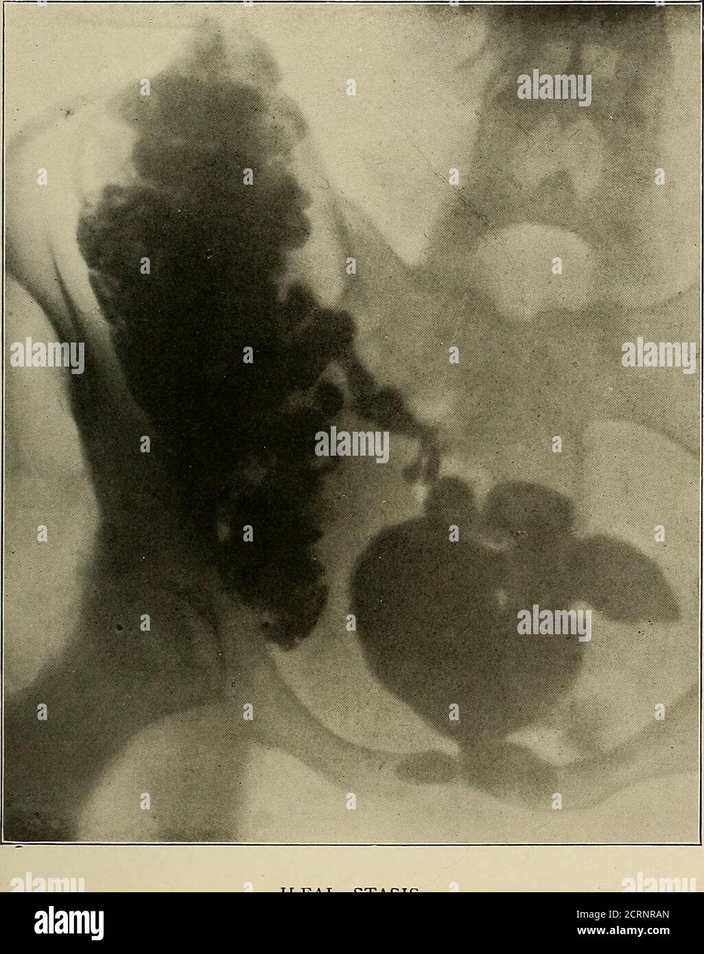 . A text-book of radiology . AN APPROXIMATELY NORMAL STOMACH. Which is ...