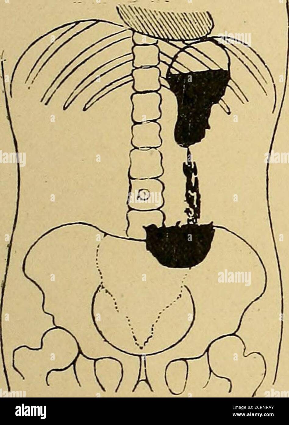 Gastric ulceration hi-res stock photography and images - Alamy