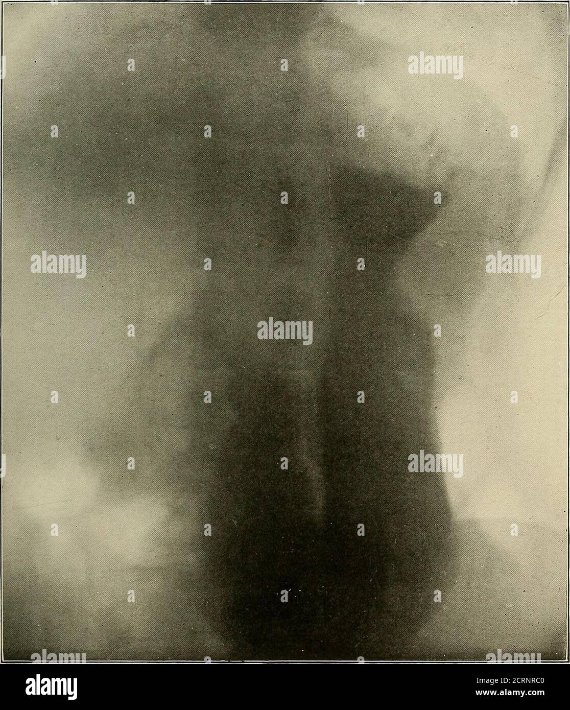 . A text-book of radiology . THE SEMI-CIRCULAR SHADOW ABOVE THE ...