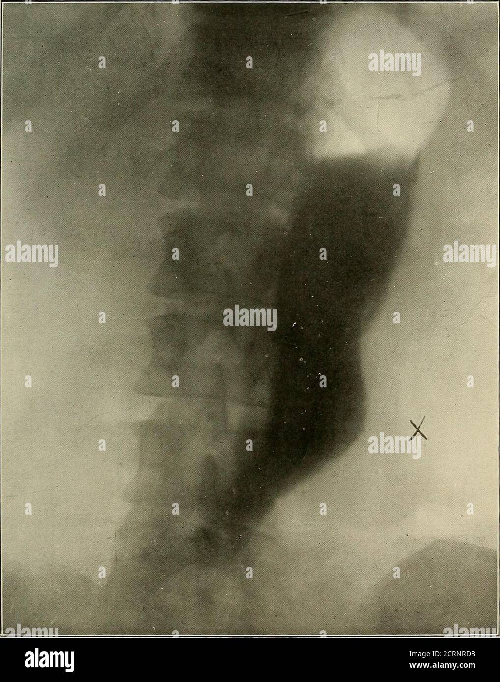 Normal stomach x ray hi-res stock photography and images - Alamy