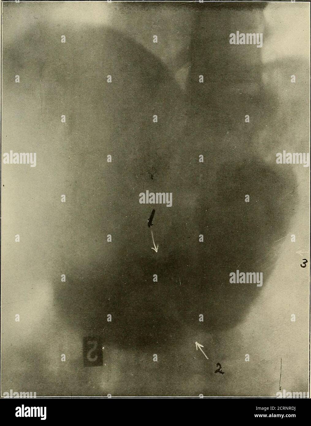 . A text-book of radiology . ATONIC STOMACH.The organ is unable to hold ...