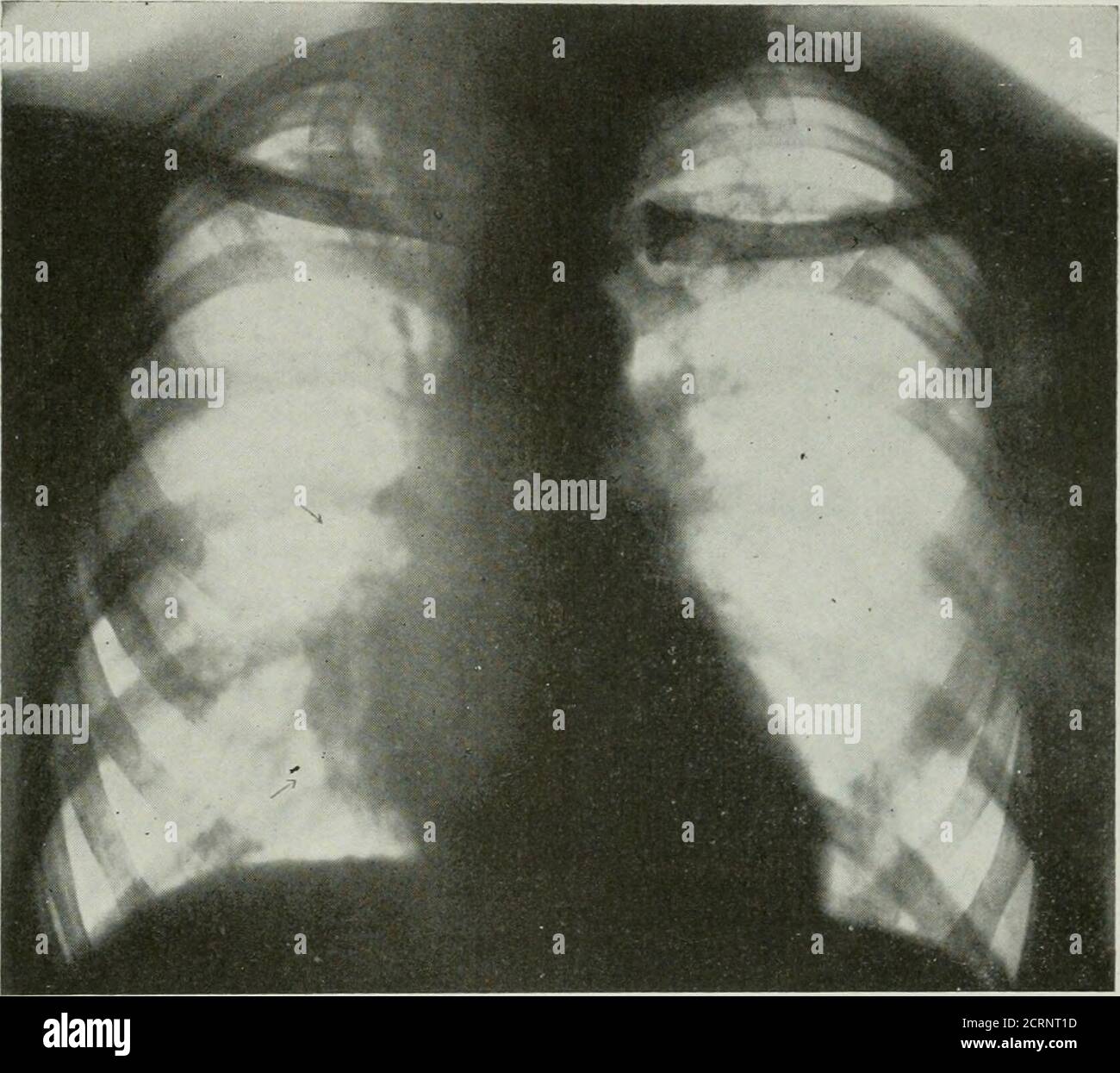 Congenital syphilis hi-res stock photography and images - Alamy