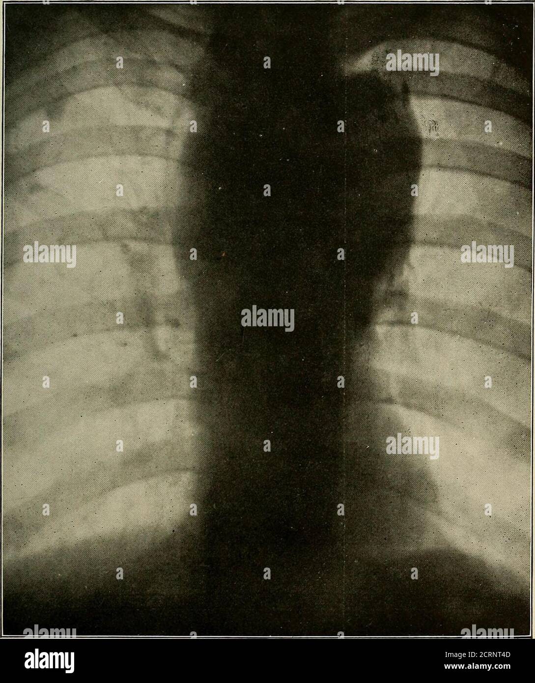 . A text-book of radiology . ADVANCED CASE OF PULMONARY TUBERCULOSIS ...