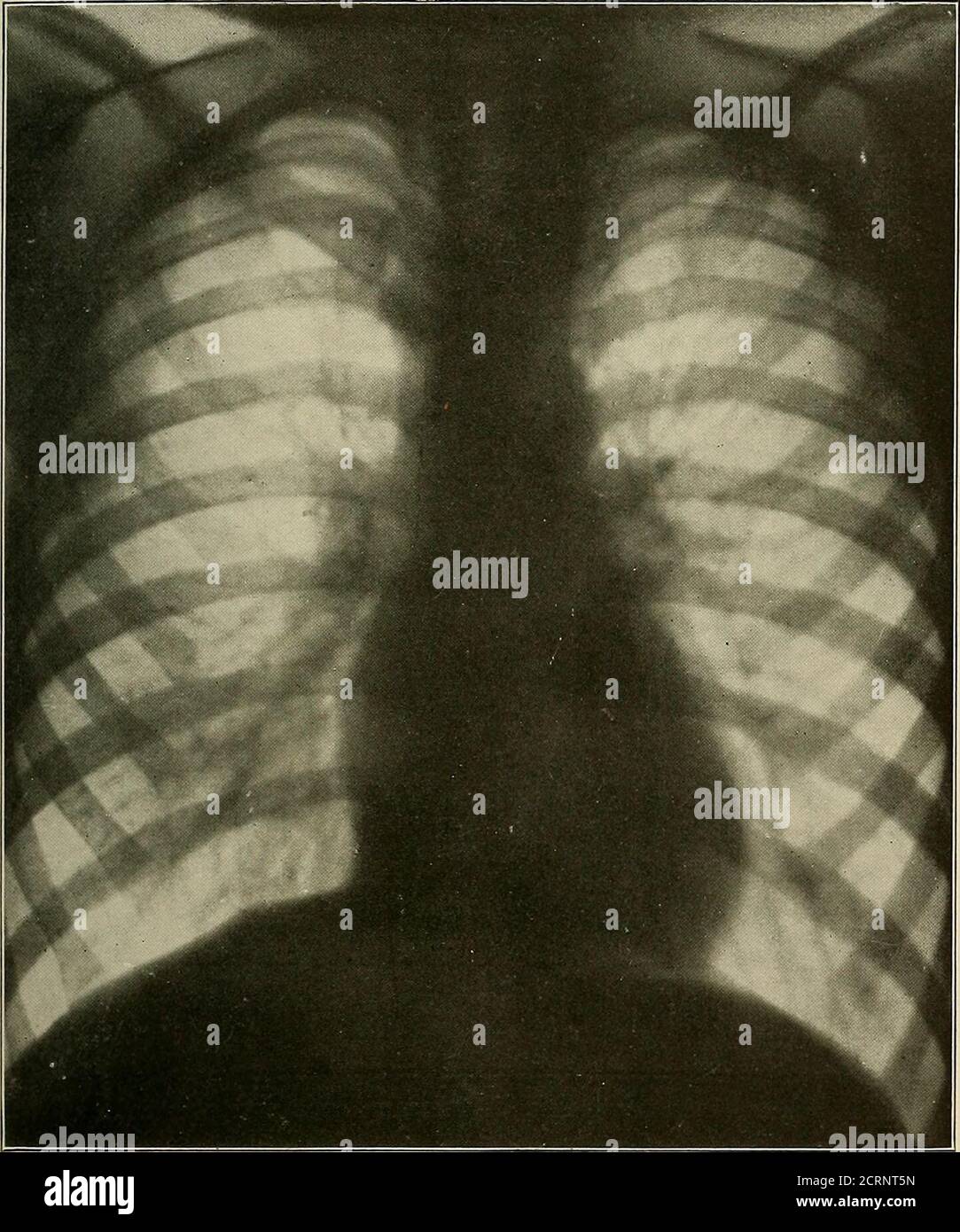 . A text-book of radiology . SHOWING CHEST IN RIGHT-ANTERIOR-OBLIQUE ...