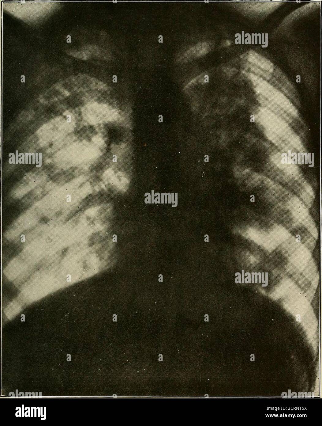 . A text-book of radiology . EARLY PULMONARY TUBERCULOSIS. NO PHYSICAL ...