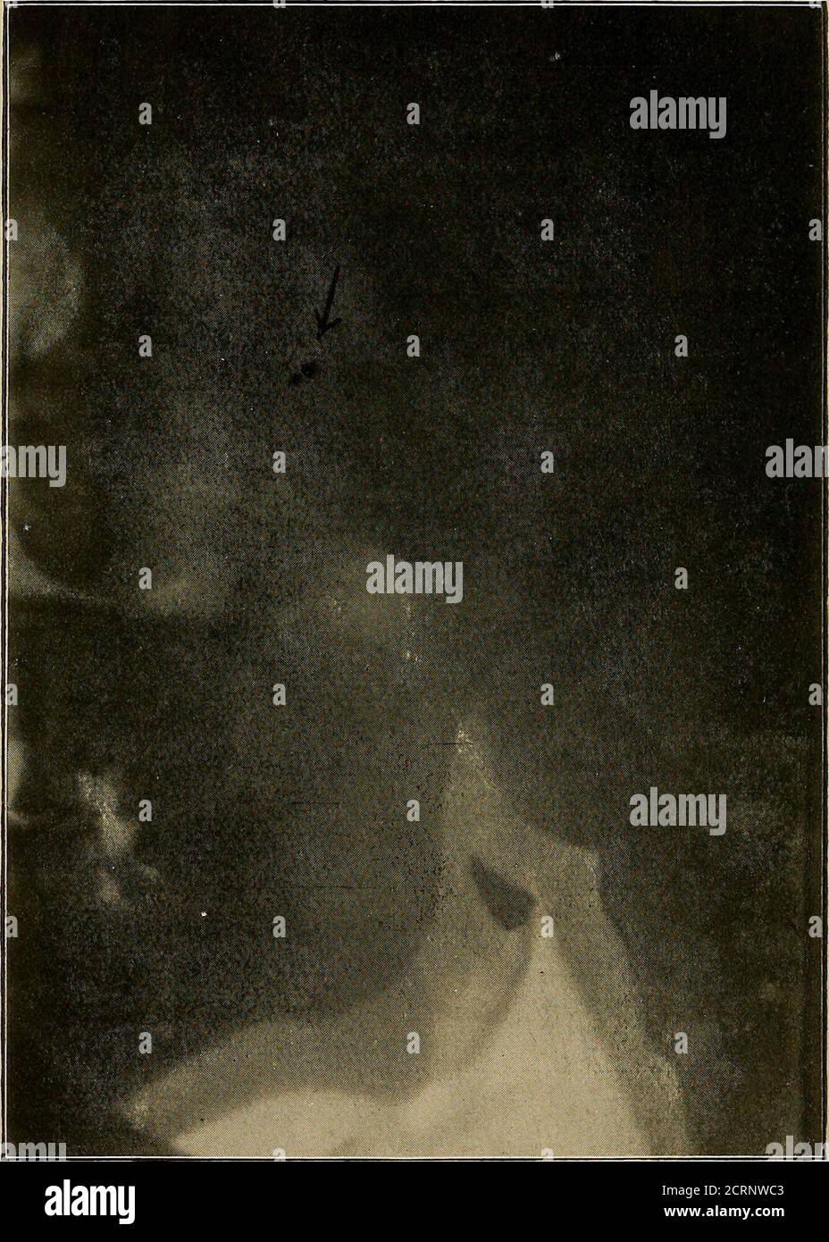 . A text-book of radiology . Fig. 51. From Case of Acromegaly. Cavity ...
