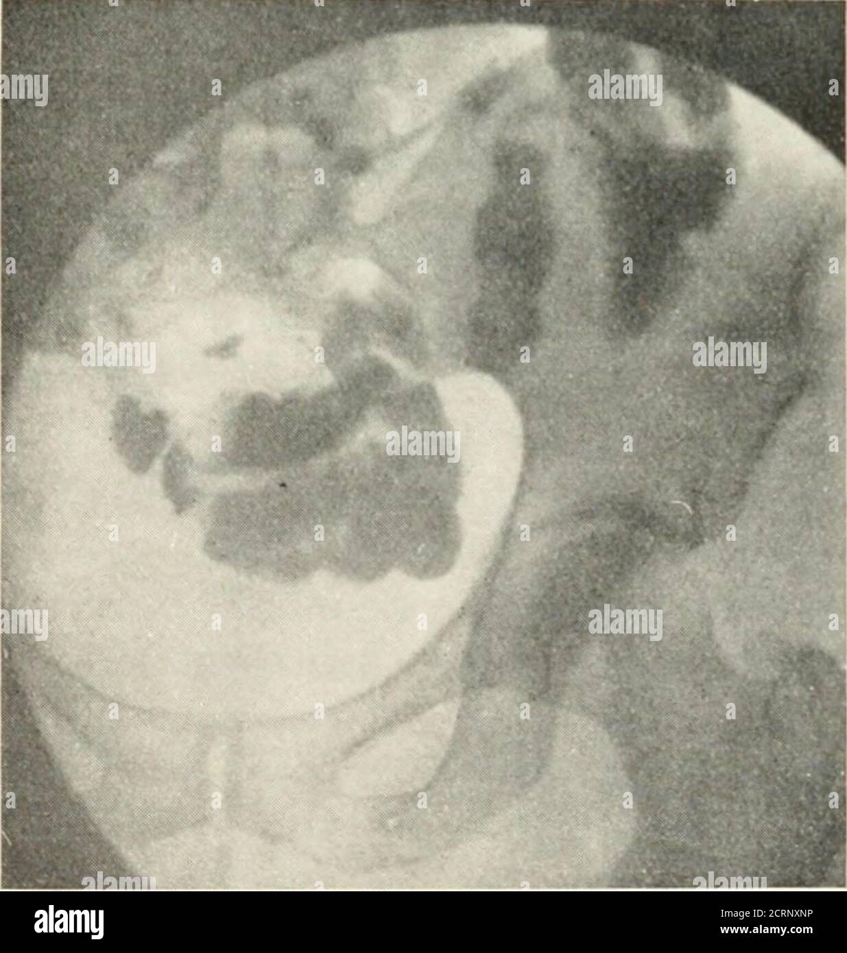 Gastric ulcer x ray hi-res stock photography and images - Alamy