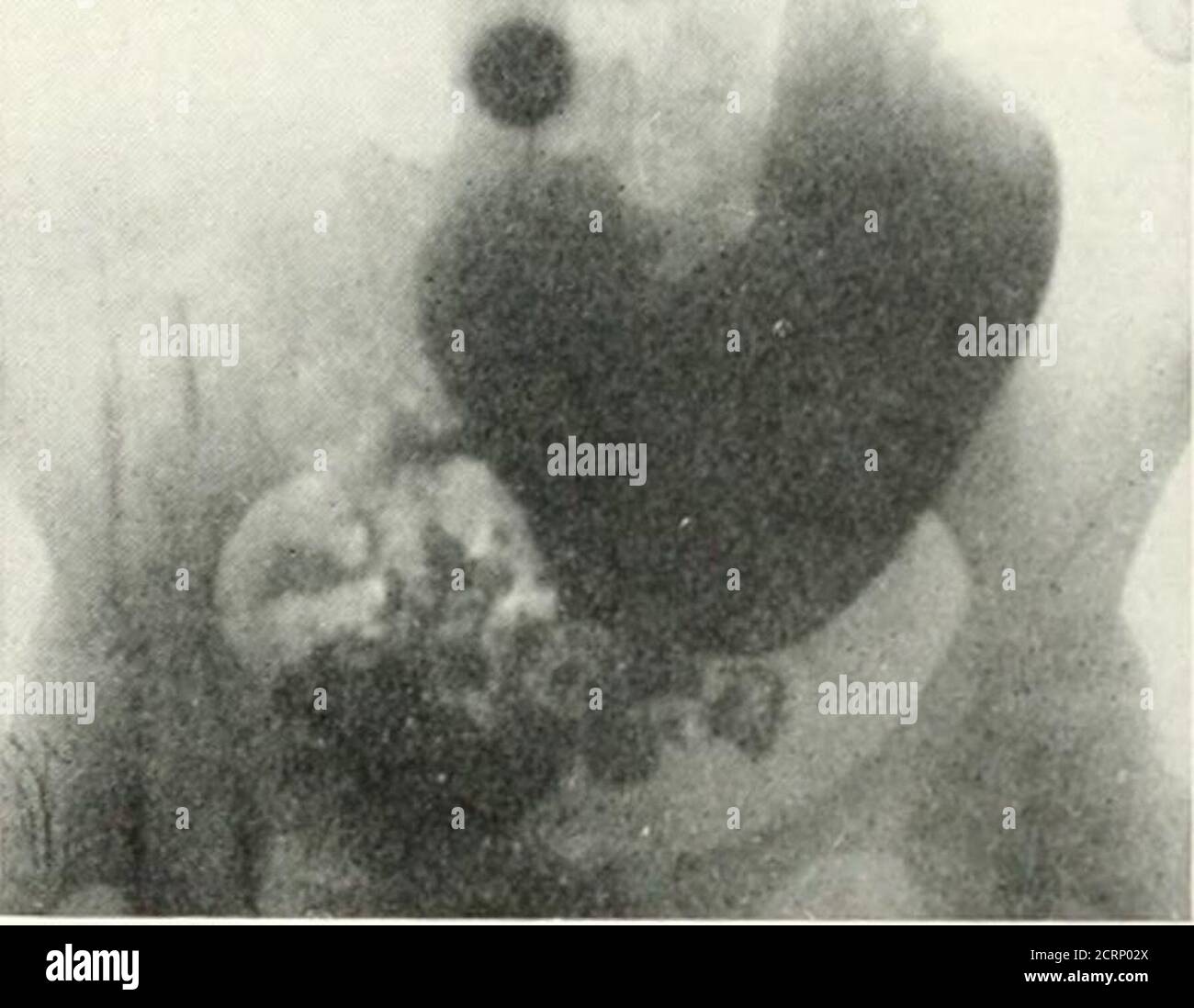 . Radiography, x-ray therapeutics and radium therapy . Fig. 164.—The ...