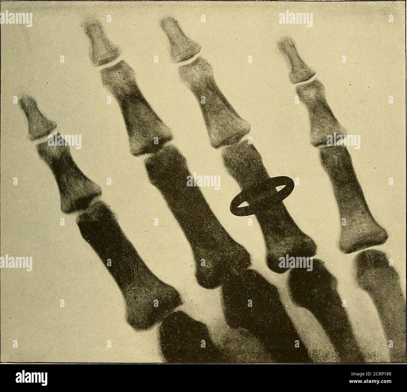 Rayons x de la main hi-res stock photography and images - Alamy