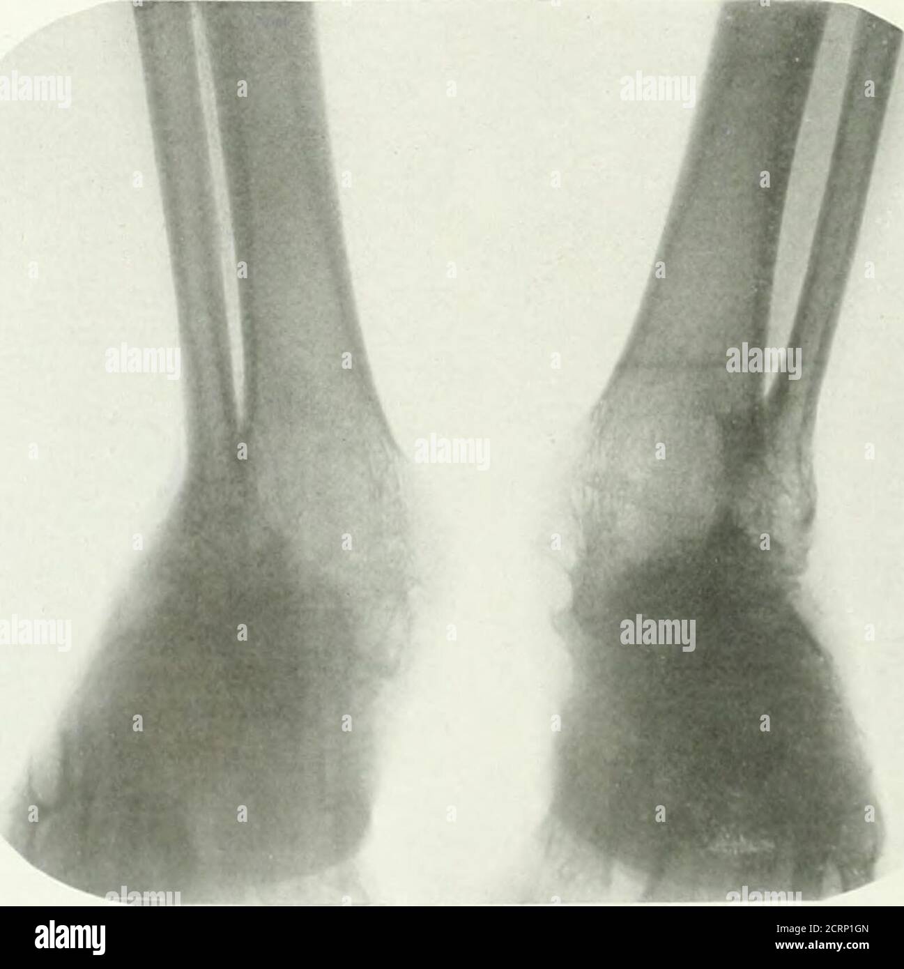 Smallpox lesions hi-res stock photography and images - Alamy