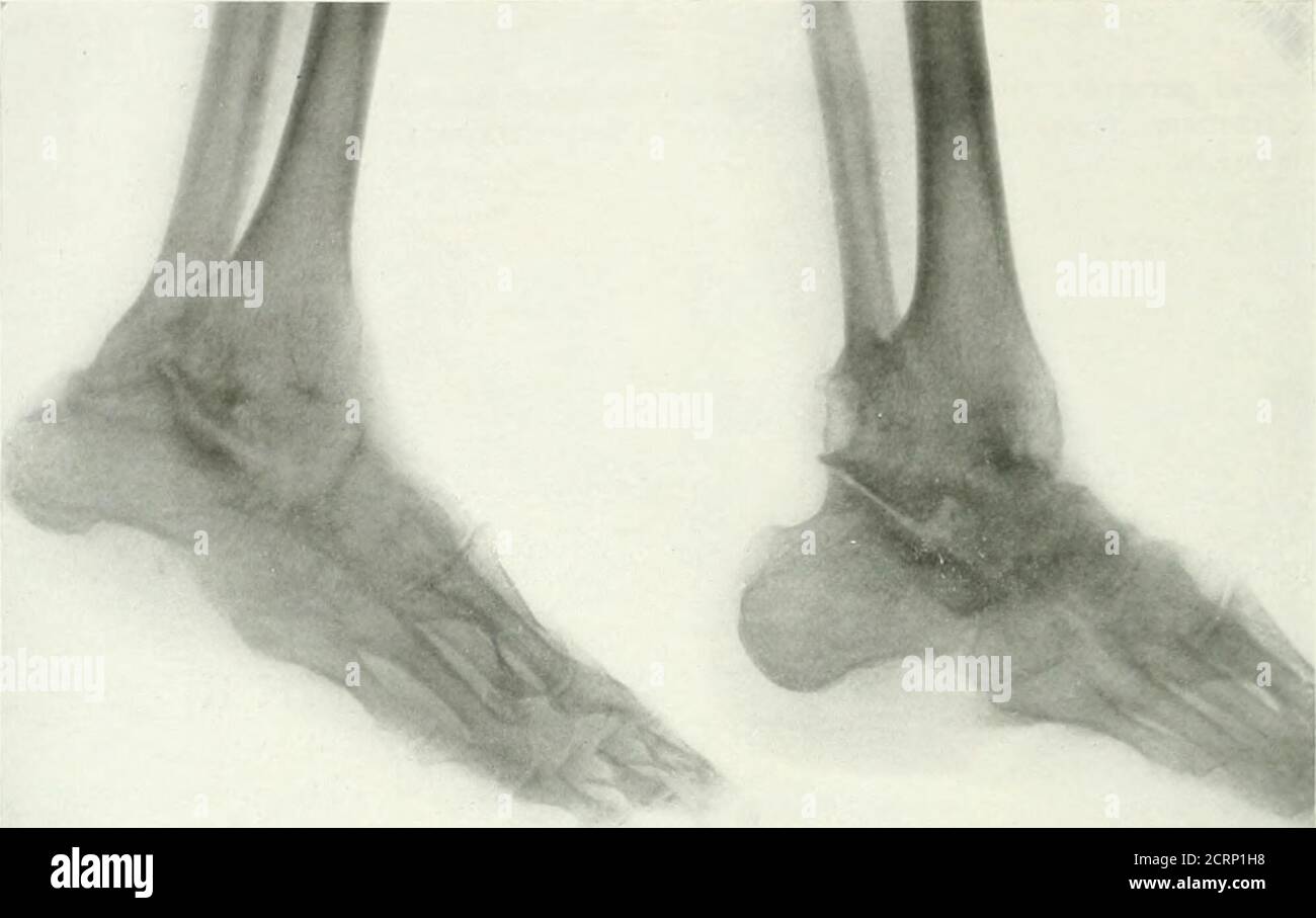 Smallpox lesions hi-res stock photography and images - Alamy