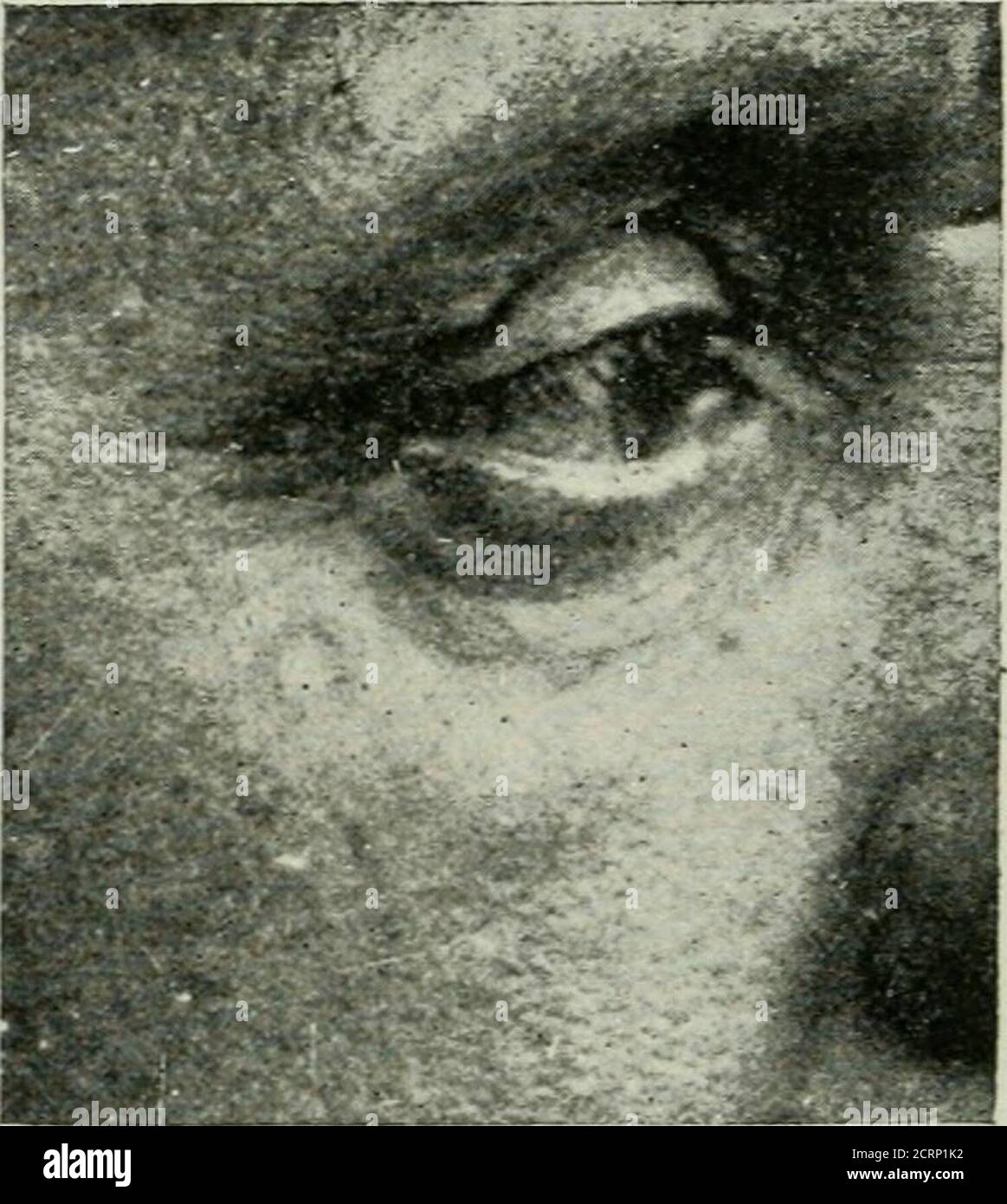 Rodent ulcer hi-res stock photography and images - Alamy