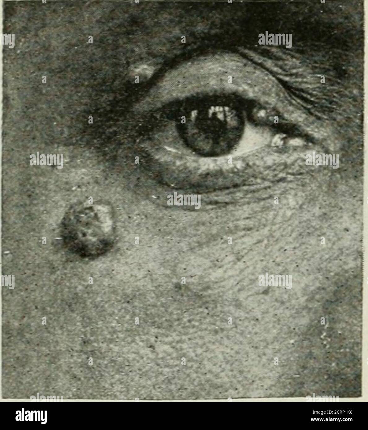 Rodent ulcer hi-res stock photography and images - Alamy