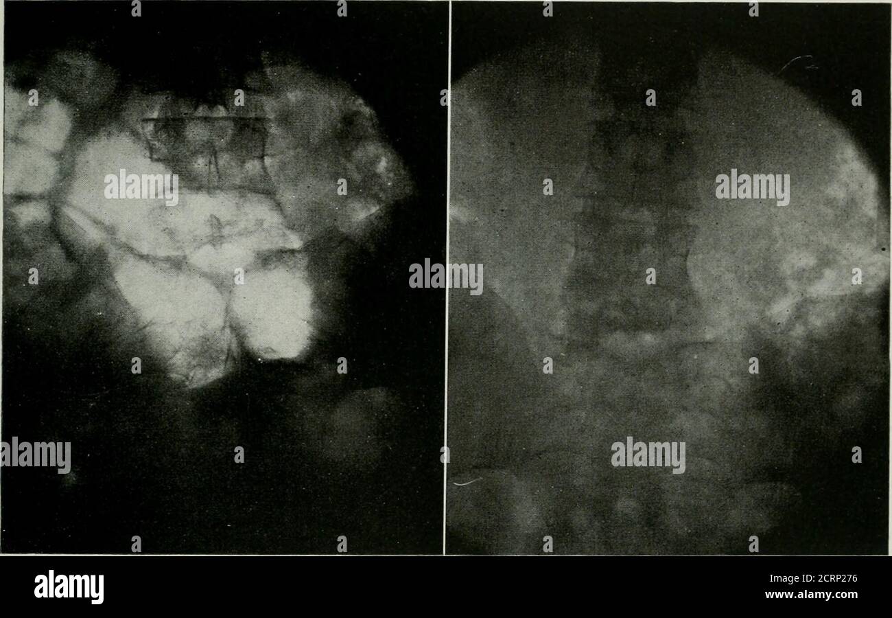 Perman tube hi-res stock photography and images - Alamy