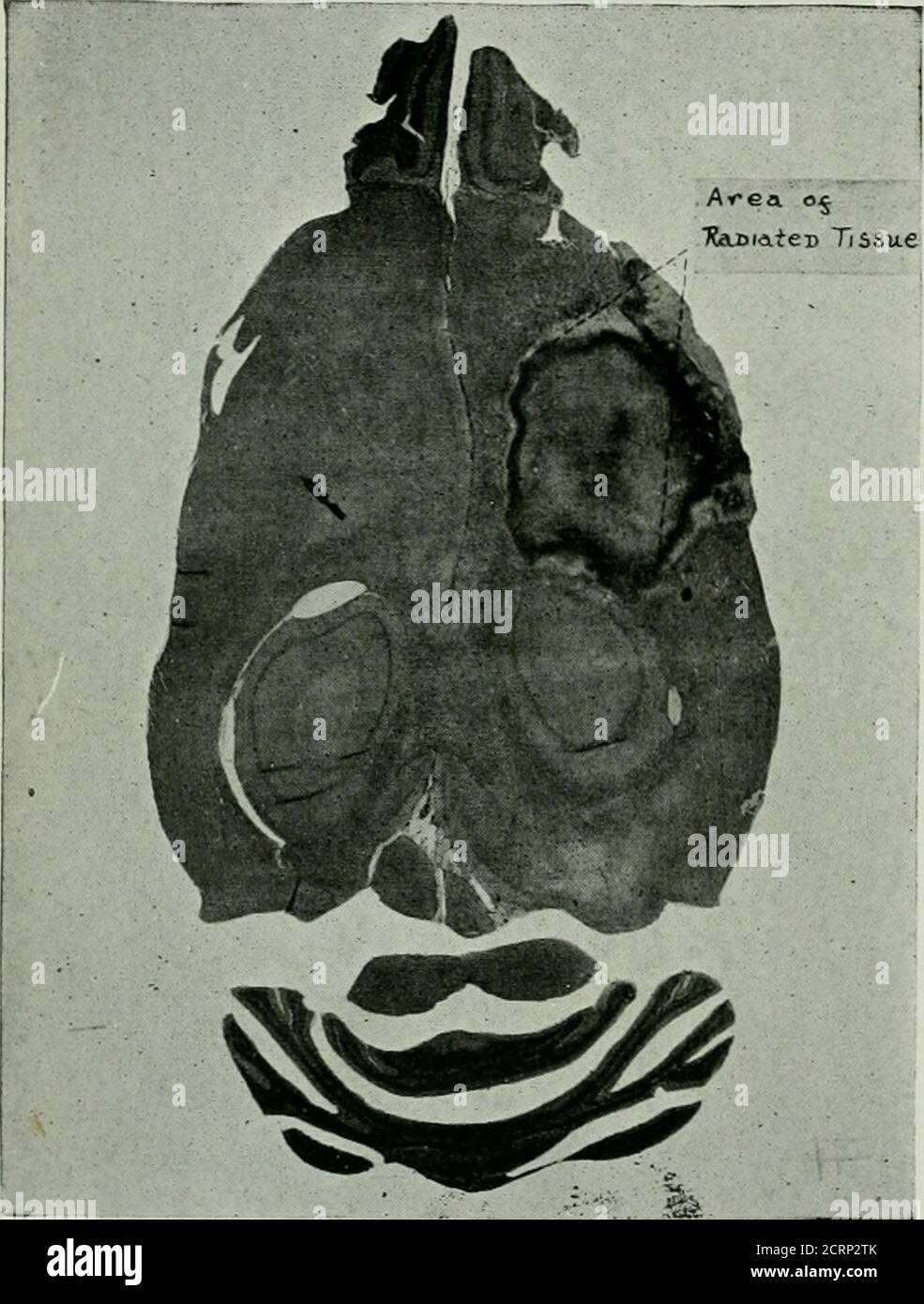 Destroyed brain cells hi-res stock photography and images - Alamy