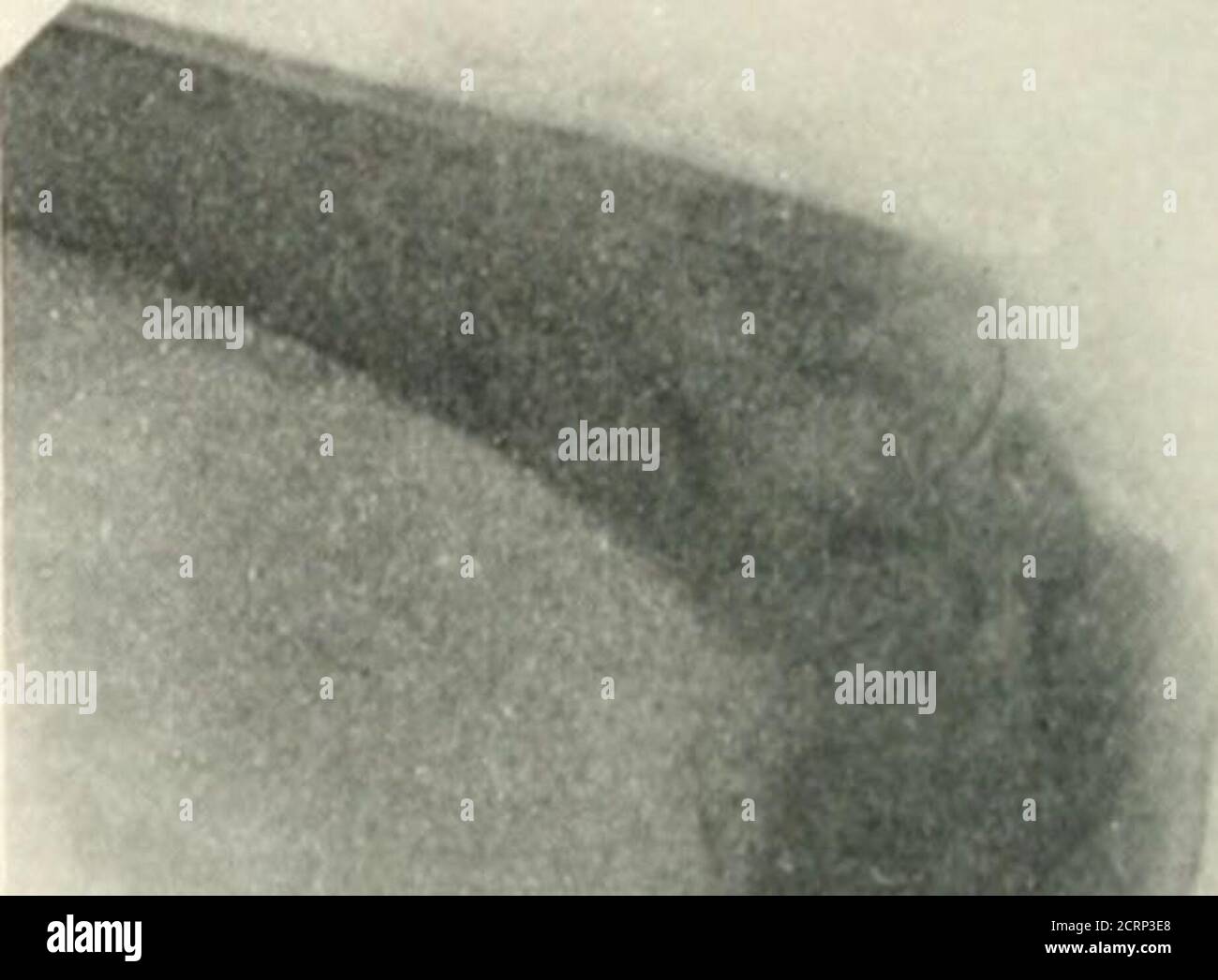 Caseation hi-res stock photography and images - Alamy