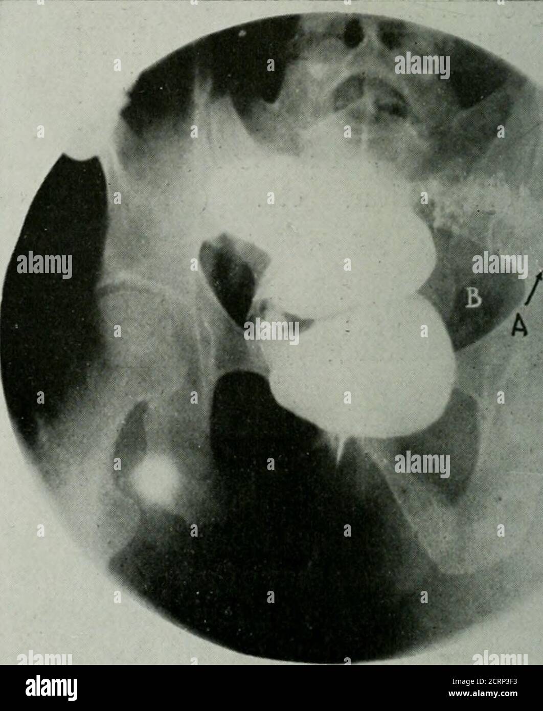 Diverticula sigmoid colon hi-res stock photography and images - Alamy