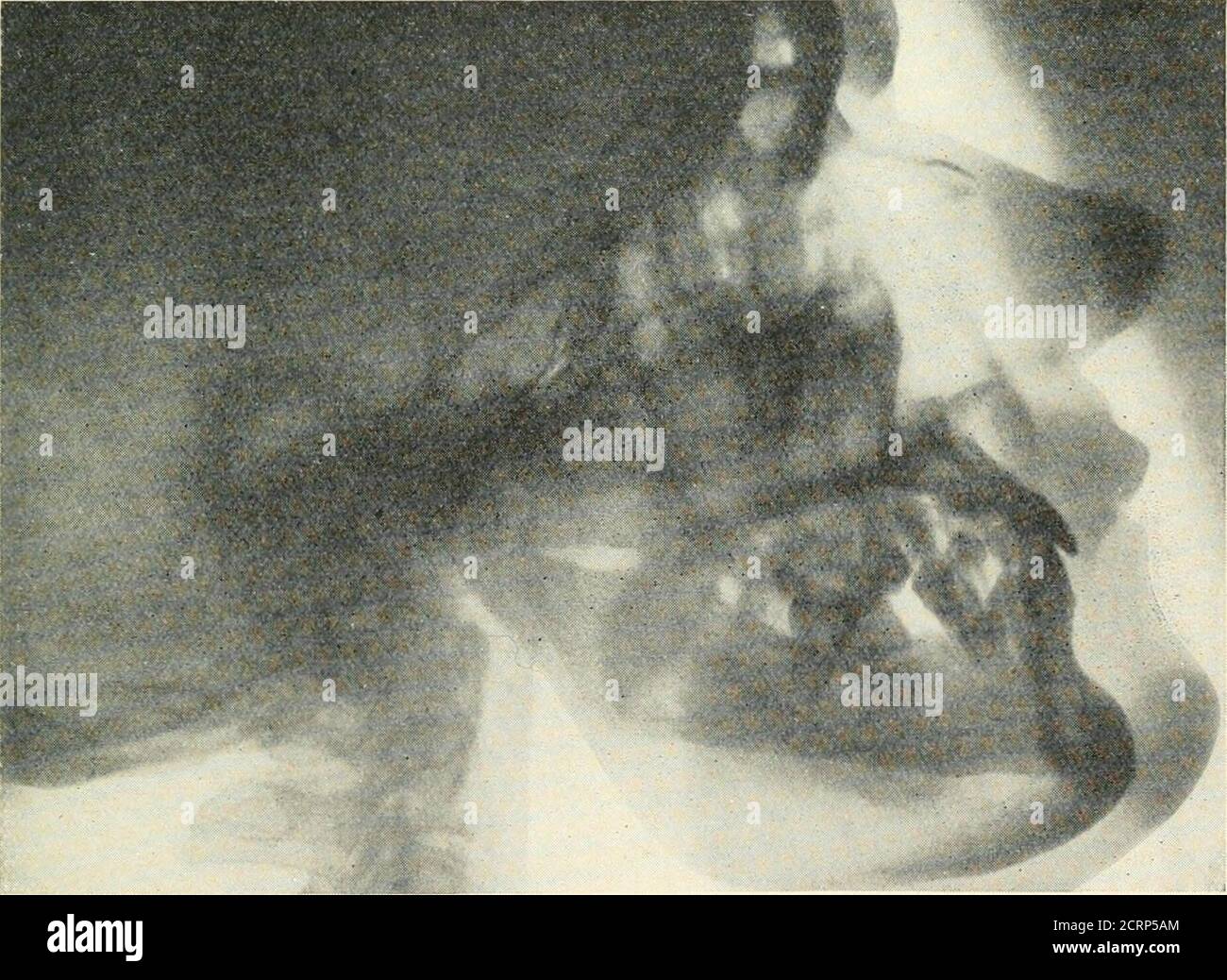 Orbital fracture hi-res stock photography and images - Alamy