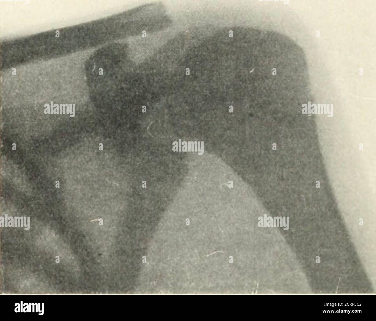 Normal shoulder joint x ray hi-res stock photography and images - Alamy