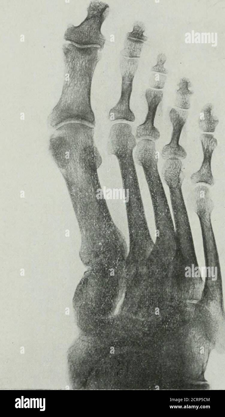 Hallux metatarsal phalangeal hi-res stock photography and images - Alamy