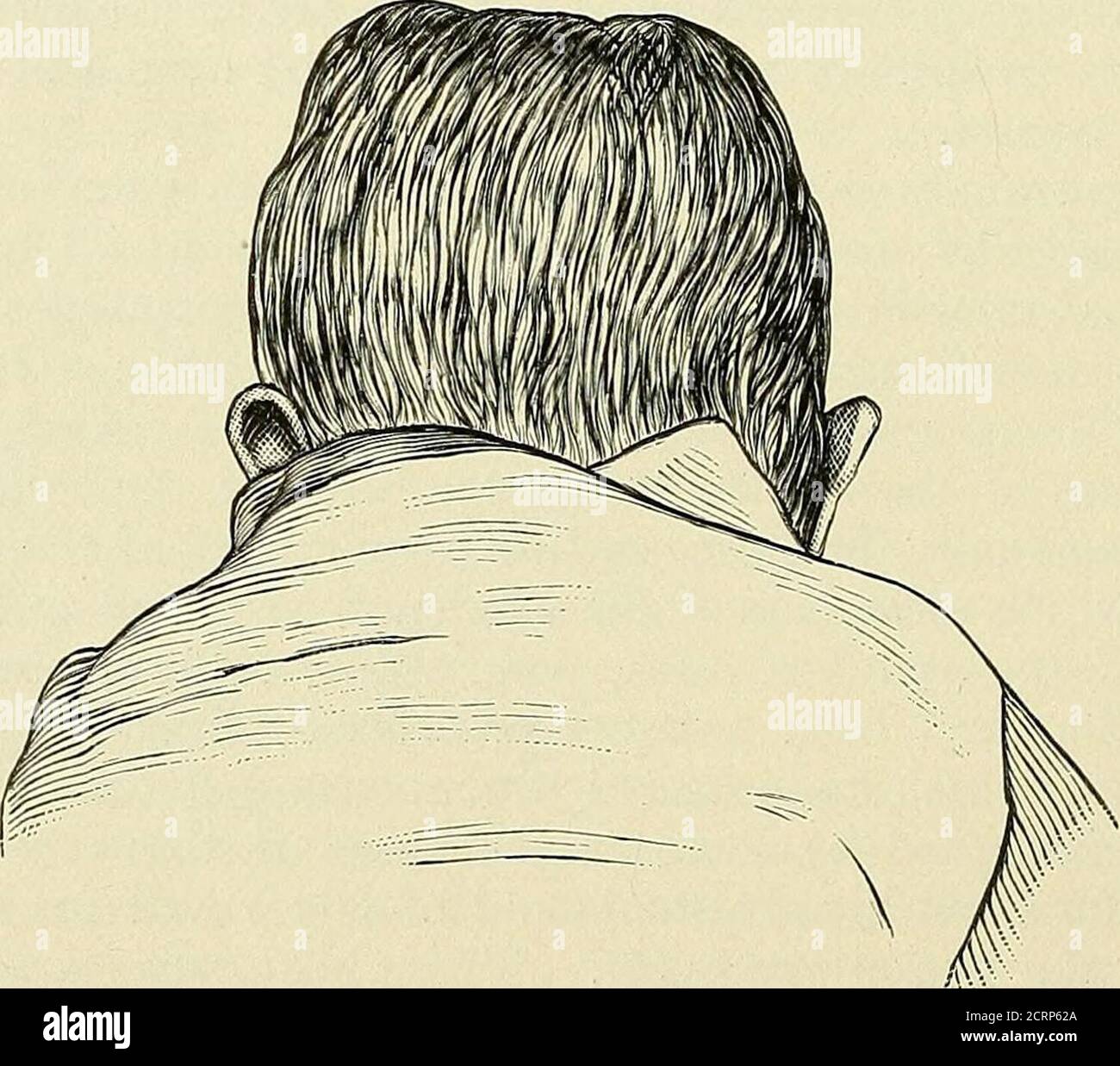 Caput succedaneum hi-res stock photography and images - Alamy