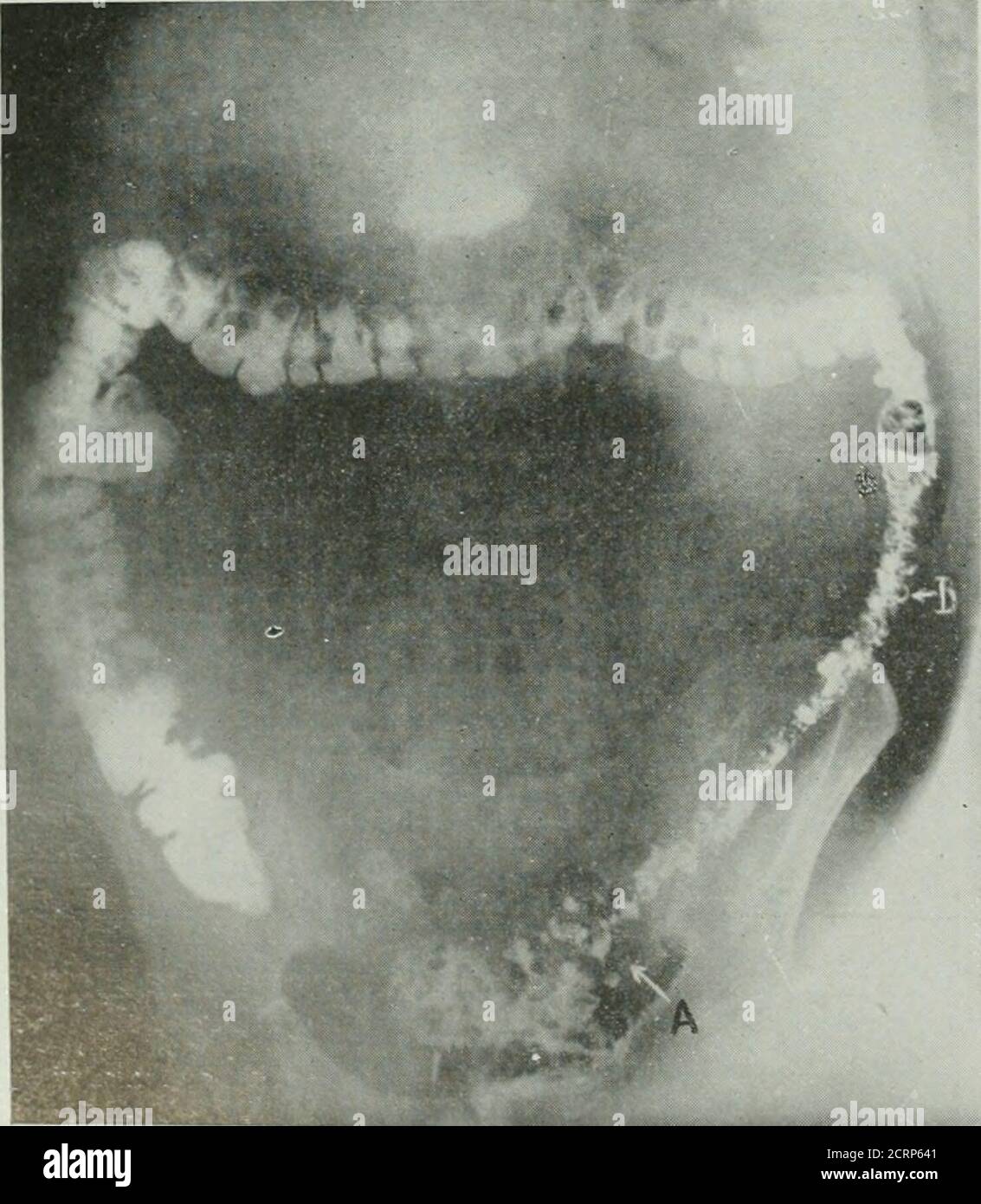 Diverticula colon hi-res stock photography and images - Alamy