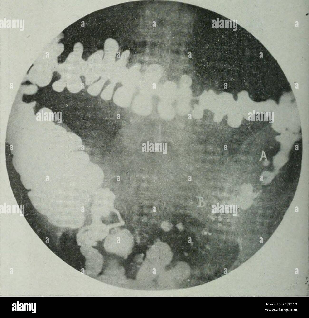 Diverticula colon hi-res stock photography and images - Alamy