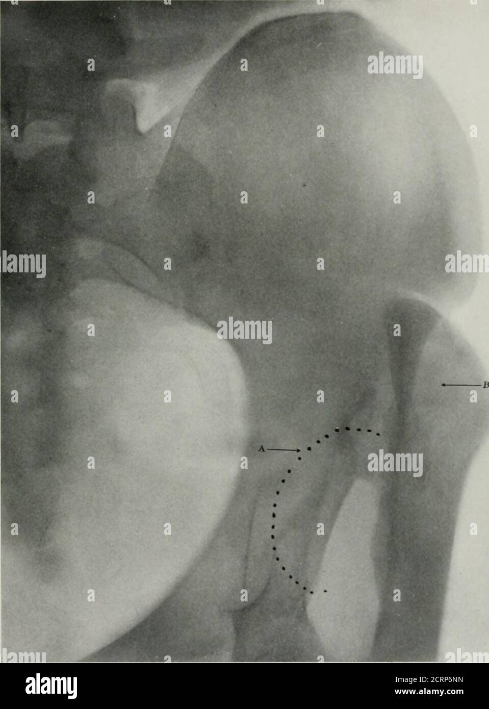 Greater trochanter hi-res stock photography and images - Alamy