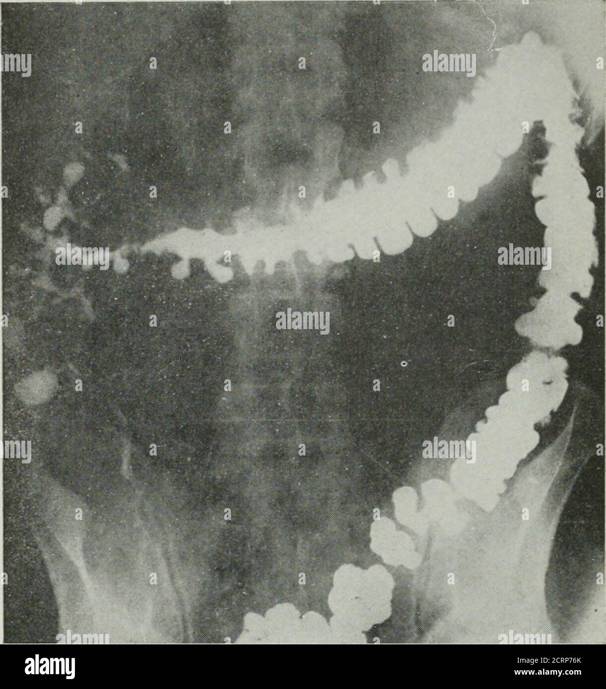 Small intestine perforation hi-res stock photography and images - Alamy